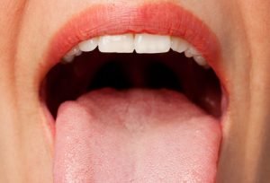 Tengo una verruga en la lengua | Causas, diagnóstico y tratamiento